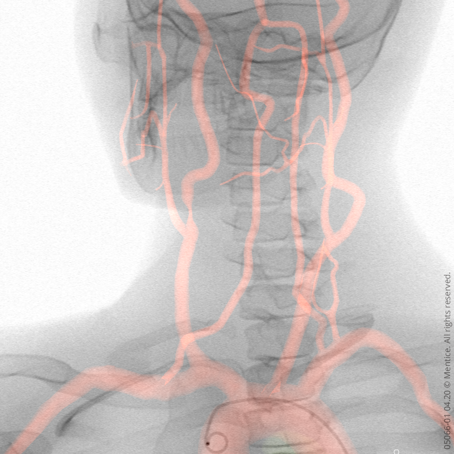 Carotid Intervention | Software